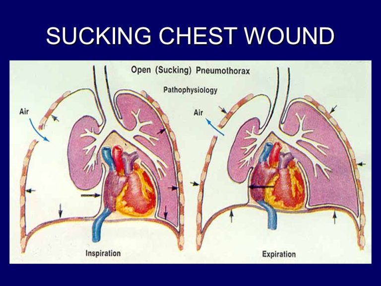 Sucking Chest Wounds – georgiaemsacademy.com